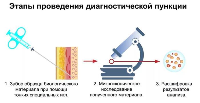 Что такое пункция и как она применяется в медицине